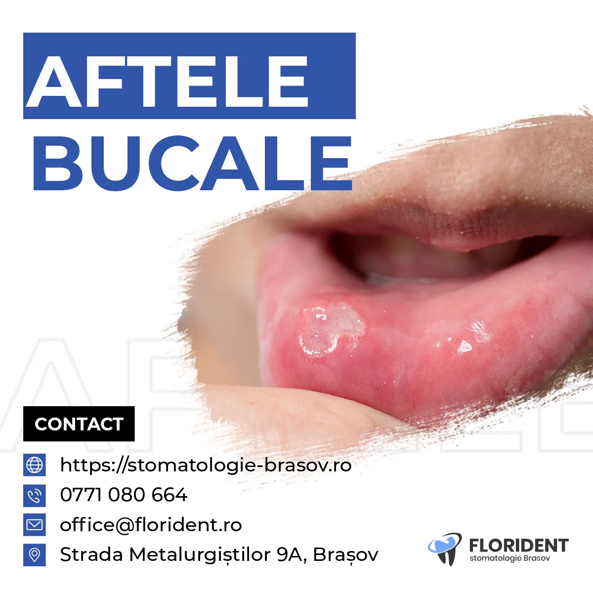 Aftele bucale: Cauze, Simptome și Tratament | Florident