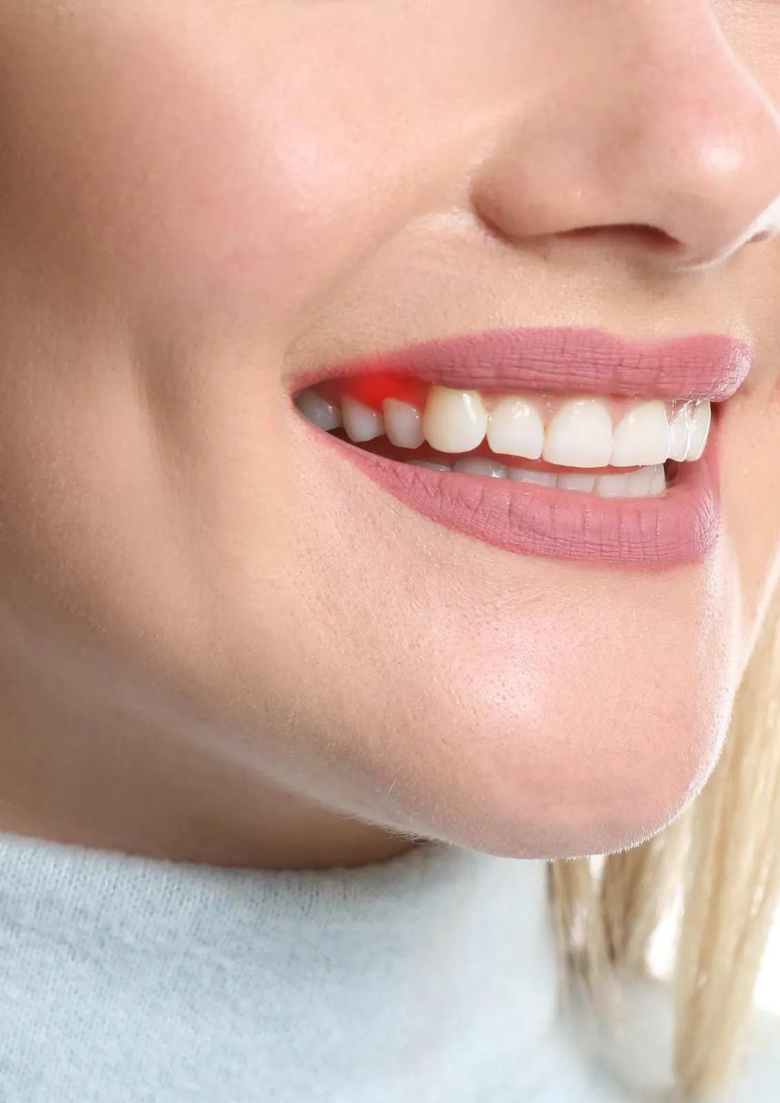 Paradontologie | Florident Brasov | Clinica de Stomatologie